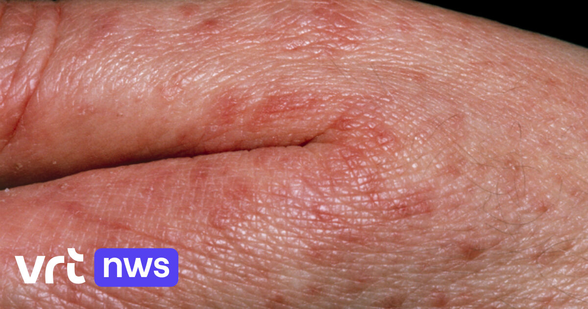 Schurft of scabies? Iedereen kan het krijgen | VRT NWS Nieuws