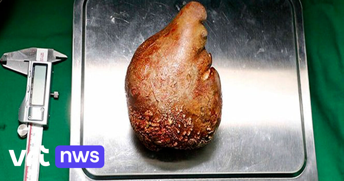 Grootste niersteen ooit verwijderd bij man in Sri Lanka | VRT NWS: nieuws