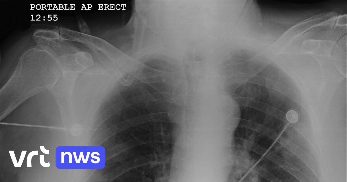 Nieuwe behandeling van rokerslong goedgekeurd in EU: "Optie voor zowat 220.000 personen" | VRT ...