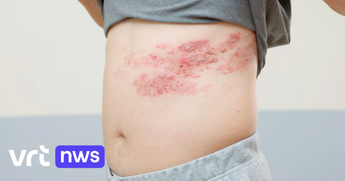 1 op de 5 krijgt ooit gordelroos of zona en dat kan erg pijnlijk zijn, maar hoe gevaarlijk is ...