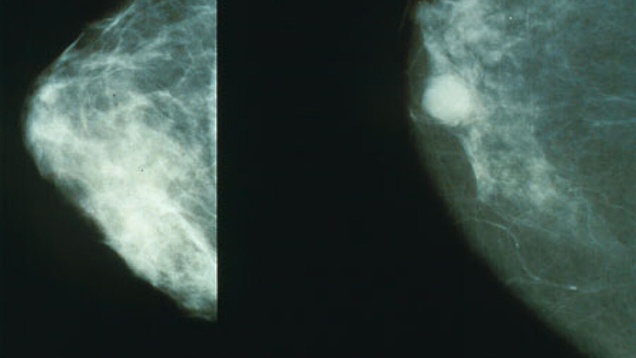 Nieuwe bloedtest spoort piepkleine sporen van borstkanker in vroeg ...