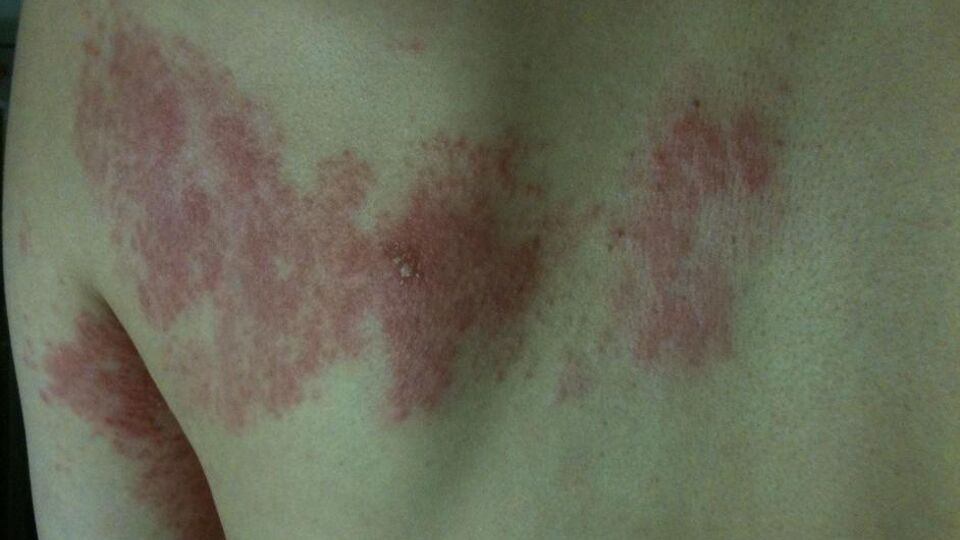 Hoge Gezondheidsraad beveelt vaccin tegen zona aan voor iedereen vanaf ...